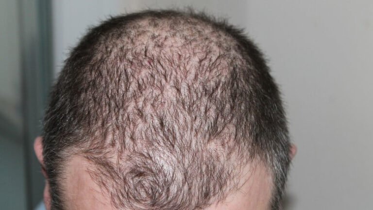 Haarausfall Männer: So stoppst Du ihn zuverlässig